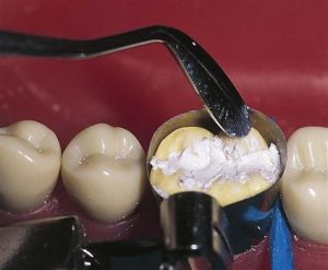 Tips on how to (and why you should) use Geristore restorative material